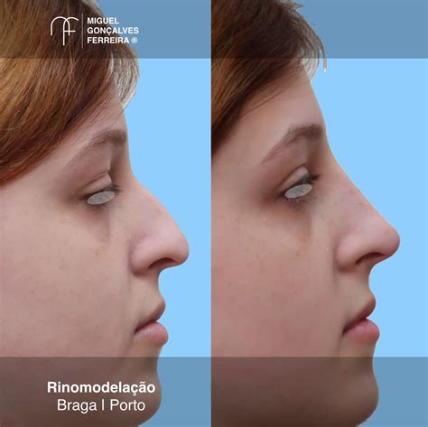 Rinomodelação O Que É Antes Bem Como Depois Consideração Quem Pode