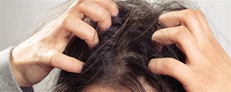 Sores On The Scalp Guide To Prevention And Treatment