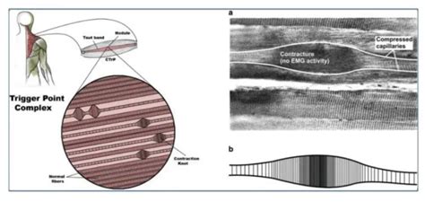 Trigger Point Referral Patterns Head And Neck} Dental Sleep Medicine In Gulfport Ms