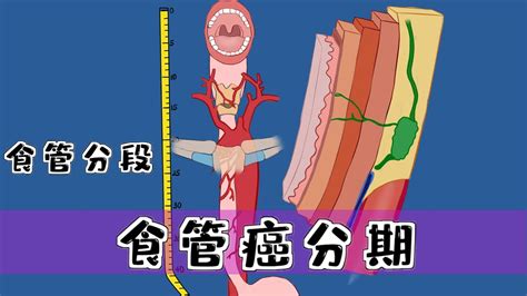 医学记忆漫画 【食管分段】和【食管癌分期】carcinoma Of Esophagus Youtube