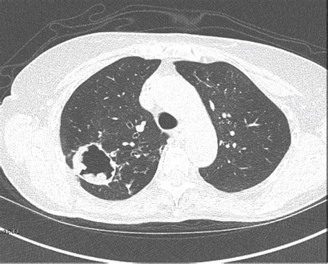 Outcomes Of Robotic Surgery For Patients With Pulmonary Nontuberculous Mycobacterial Disease