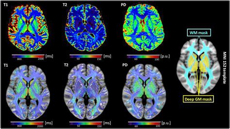Focal Epilepsy Without Overt Epileptogenic Lesions No Evidence Of Microstructural Brain Tissue