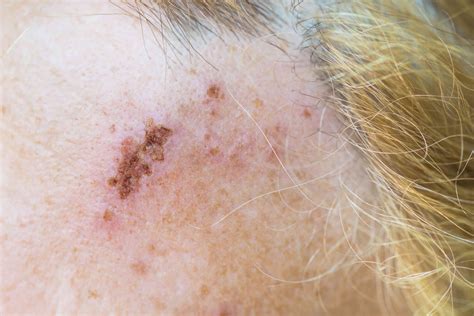 What Shingles On The Scalp Looks Like And How To Treat It