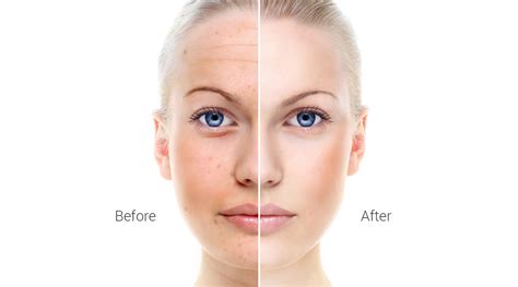 Acne Scars Dr Roscher