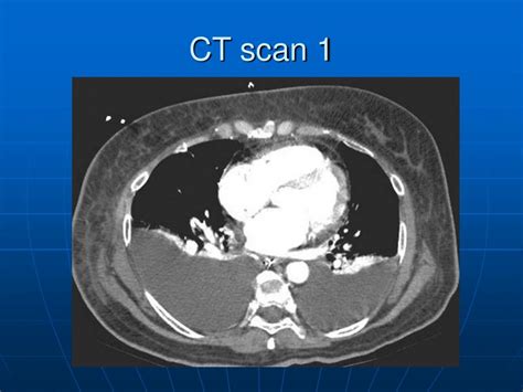 Ppt Ards Powerpoint Presentation Free Download Id1148209