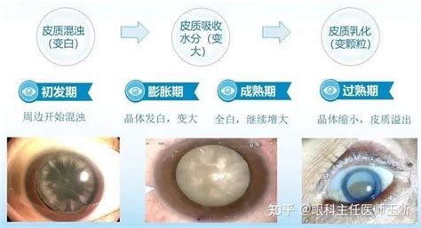 眼科知识科普青光眼和晶状体之间的关系 知乎