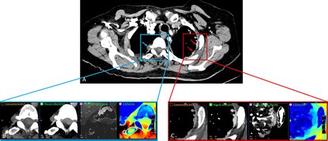 Multimodality Imaging Of The Extrapleural Space Lesions” Clinical