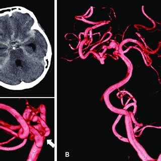 Preoperative Images Of Case 2 CT Scan At Admission Shows Diffuse