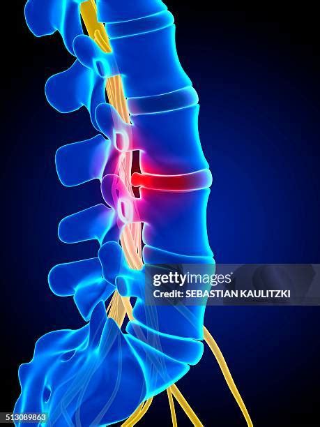 Hernia Illustration Photos And Premium High Res Pictures Getty Images