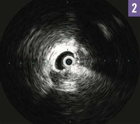 Iliac Vein Compression Syndrome Consultant360