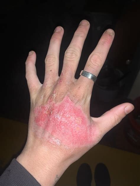 Superficial Second Degree Burn Will It Scar How Badly Rscars