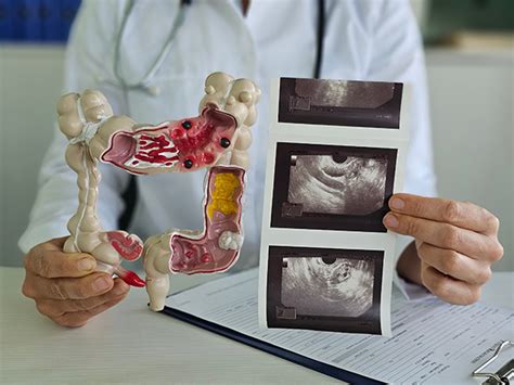 Colonoscopy In Safe And Effective Screening