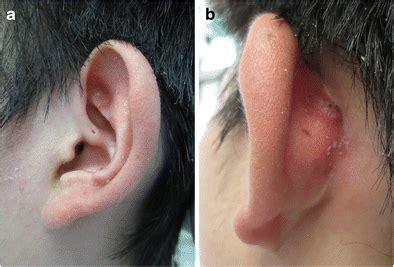 Dual Incision Approach For Excision Of Postauricular Sinus Springerlink