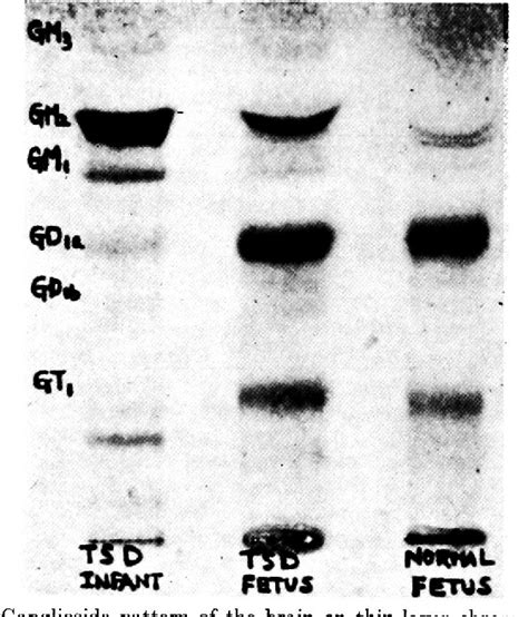 Figure 1 From Prenatal Diagnosis And Fetal Pathology Of Tay Sachs