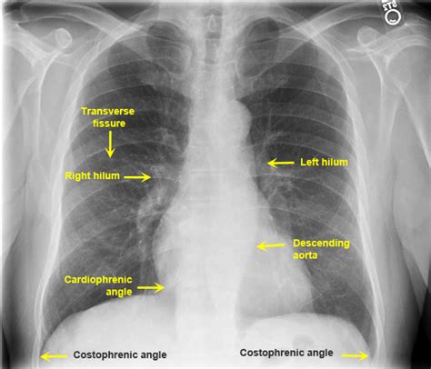 Xray Heart Labeled