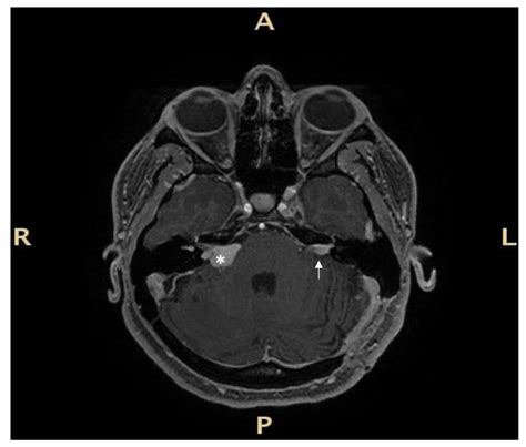 Cochlear Implantation In Intralabyrinthine Schwannoma Case Series And Systematic Review Of The