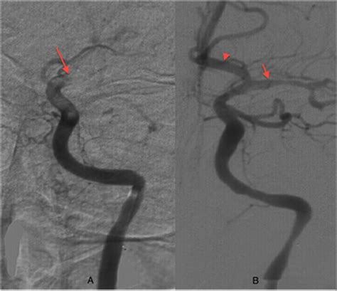 A Conventional Angiogram Showing Occlusion Of The Left Common Carotid Download Scientific