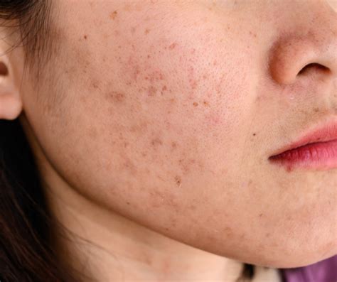 Trị Nám Tàn Nhang Tại Nhà Không Hề Khó Như Bạn Tưởng