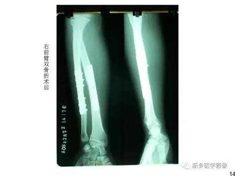 全身常见骨折X线汇总 好医术早读文章 好医术 赋能医生守护生命