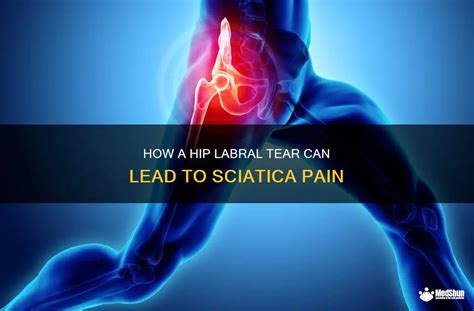 How A Hip Labral Tear Can Lead To Sciatica Pain Medshun