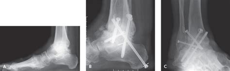 Tibiotalocalcaneal And Pantalar Arthrodesis Musculoskeletal Key