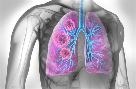 Ct Based Body Composition Analysis In Lung Cancer Prognosis