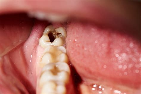 علائم کرم خوردگی دندان چیست و چگونه از آن جلوگیری کنیم؟