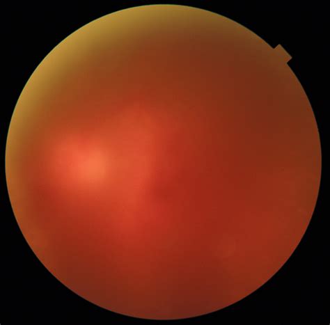 Macula And Optic Disc Detection Object Detection Dataset By Cils