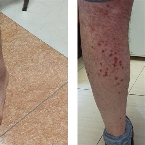 Purpura On The Lower Legs Download Scientific Diagram