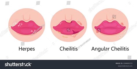 Infectious Cheilitis