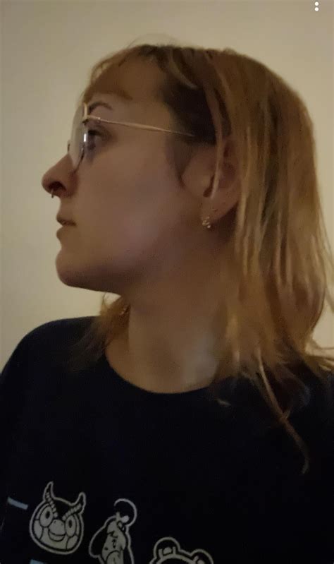 Rhinoplasty Before Vs 1 Week Post Op Rplasticsurgery