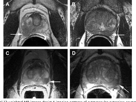 Figure 14 From Imaging Prostate Cancer Semantic Scholar