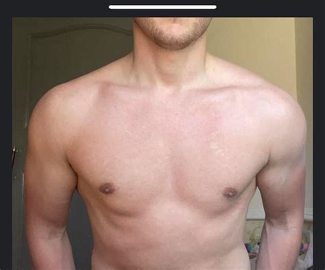 Examples Of Gyno Surgery Scars From Plastic Surgeon Michael Law Md R