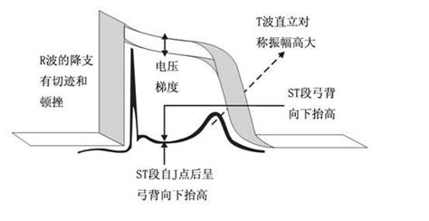 博声医疗早期复极综合征