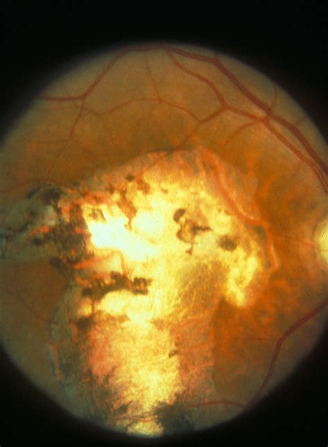 Toxoplasmose Ocular O Que é Sintomas Diagnóstico E Mais