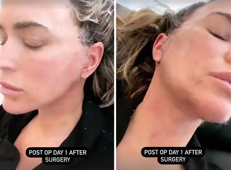 Teddi Mellencamp 40 Reveals She Got A Neck Lift