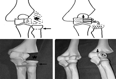 Reconstruction Of Lateral Trochlear Defect With Radial Head
