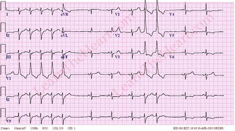 Monomorphic Non Sustained Ventricular Tachycardia Ecg Example 2