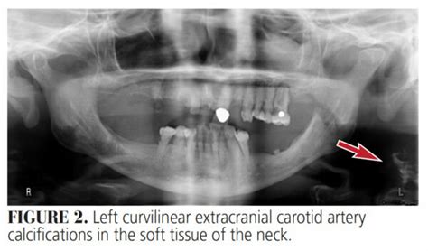 Diagnosing Incidental Thyroid Calcifications On Dental Images
