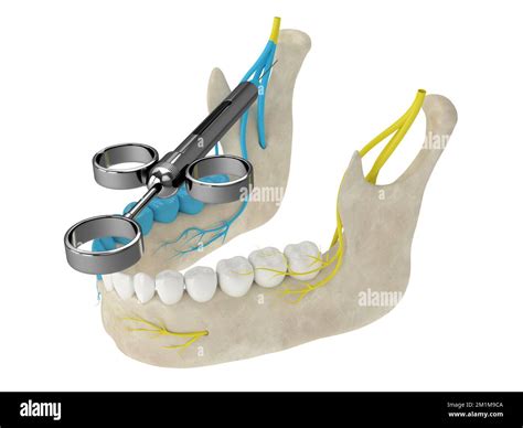 3d Render Of Mandibular Arch With Gow Gates Nerve Block Types Of Dental Anesthesia Concept
