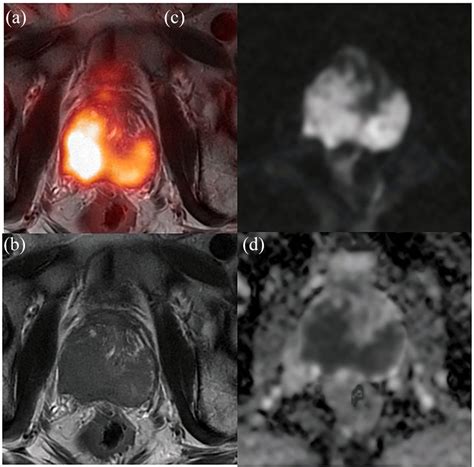 Male In His Early 50s With Newly Diagnosed Gleason 5 4 9 Prostate