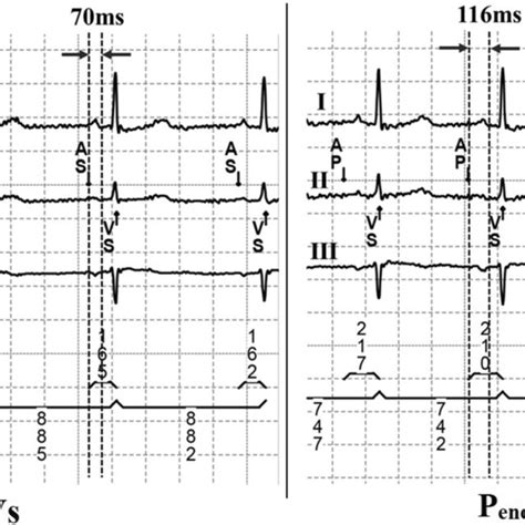 The Optimizing Algorithm Of The Optimal Av Delay P End As P End Ap