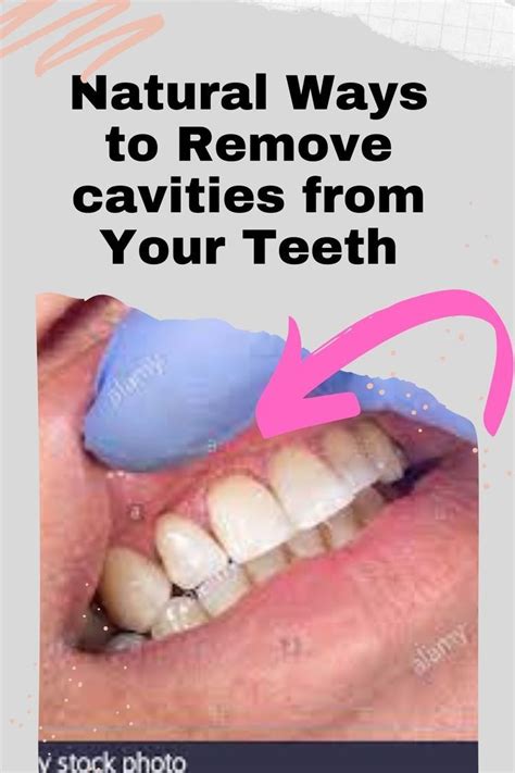 How To Fix A Cavity On Front Tooth Billi Gore