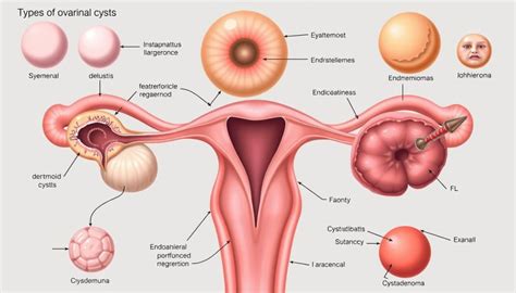 Ovarian Cyst And Miscarriage Risks Explained