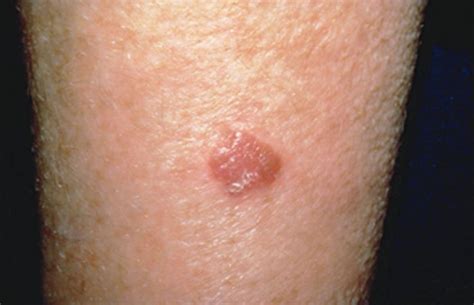 Skin Cancer Spots On Arm