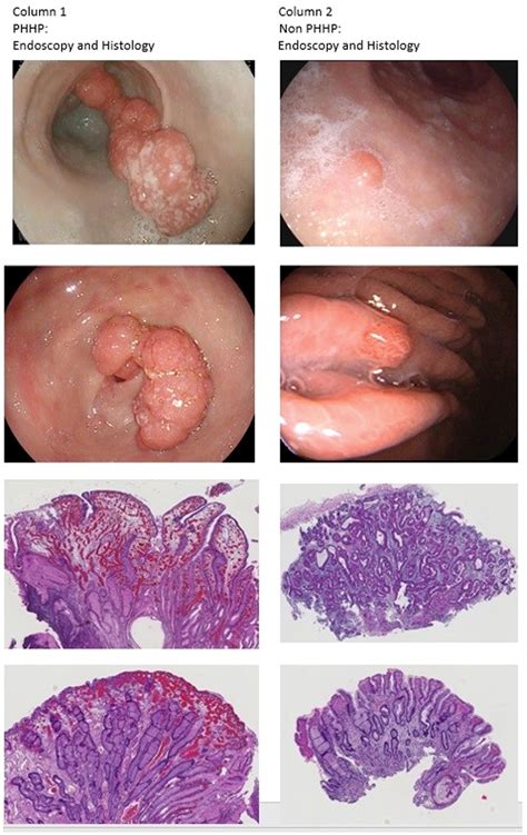 Mo1329 Gastric Portal Hyperplastic Polyps A Polypoid Variant Of Gave