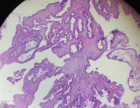 Serous Tumour Ovary