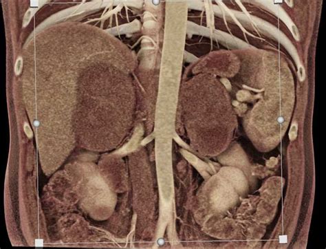 Primary Adrenal Lymphoma Adrenal Radiology Case Studies Ctisus Ct