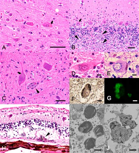 Figure 1 From Adult Onset Neuronal Ceroid Lipofuscinosis In A Shikoku