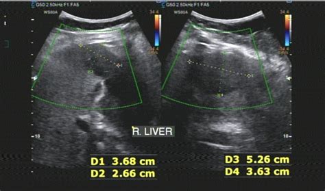 Vietnamese Medic Ultrasound Case 528 Liver Tumor Dr Phan Thanh Hai